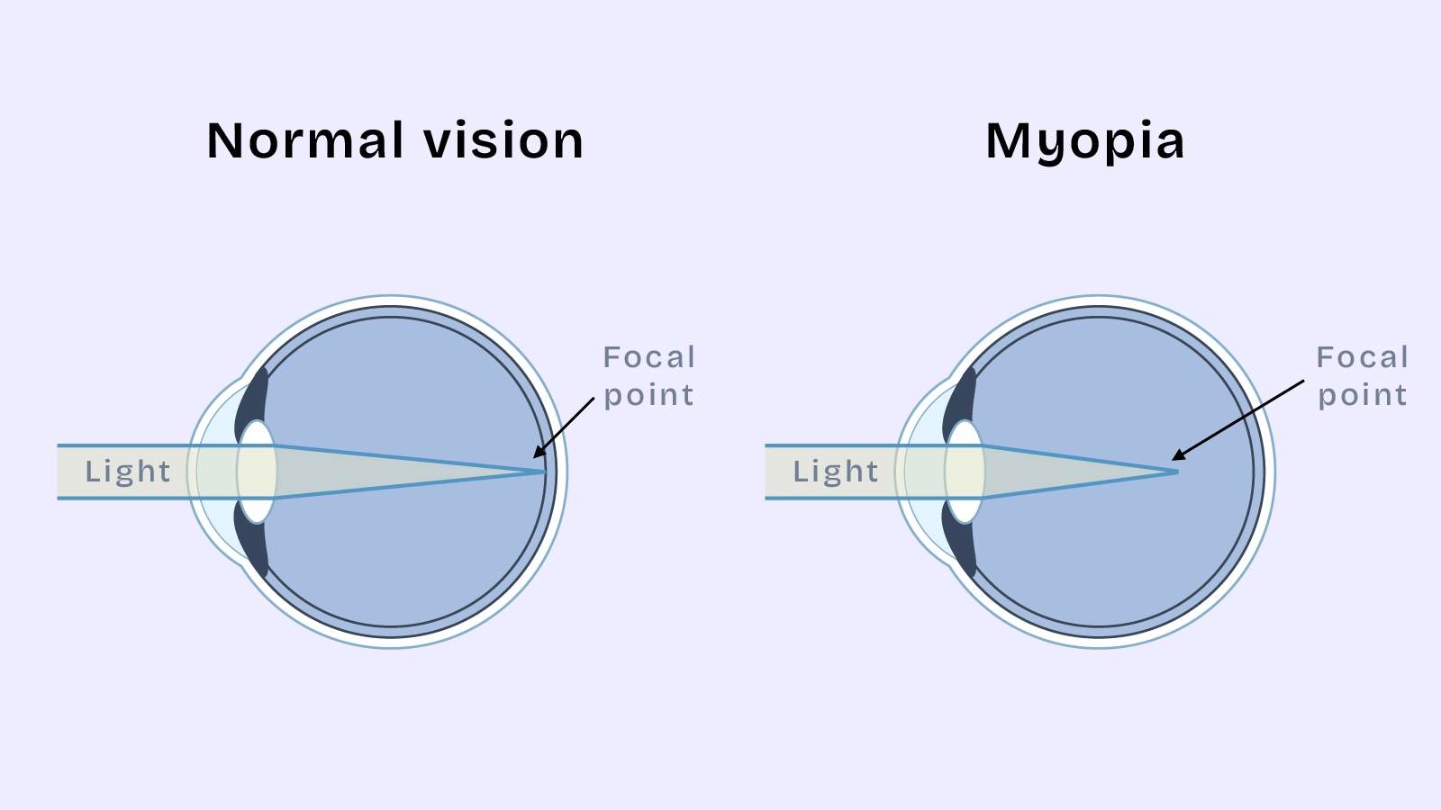 What Is Bilateral Myopia? Causes, Symptoms, and Solutions